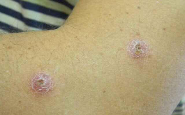 Leishmaniose : Des scientifiques israéliens développent un test ADN ...