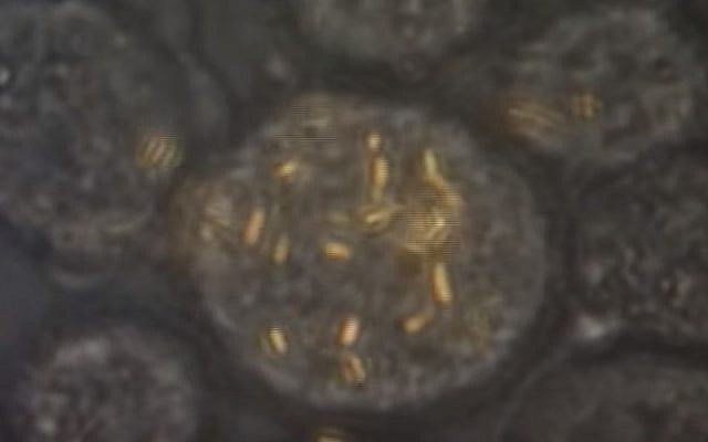 Israeli study uses gold particles to 'seek and destroy' artery ...