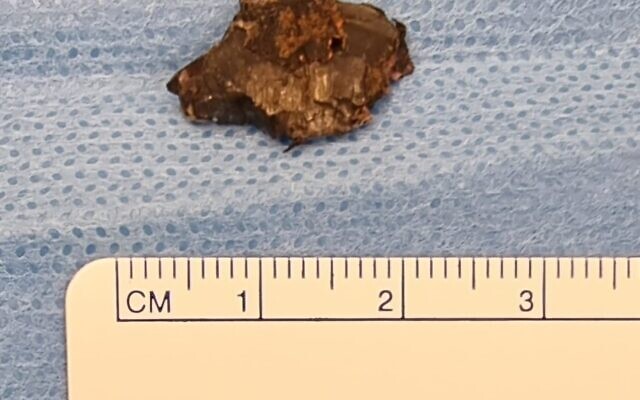 Hospital removes piece of shrapnel lodged in boy wounded in Majdal Shams attack | The Times of ...