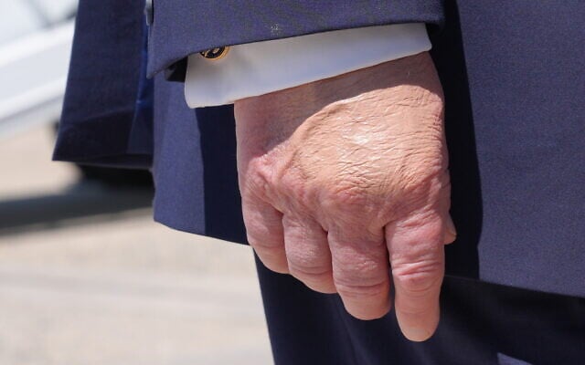 Trump in excellent health, doctor says, despite leg swelling and hand ...